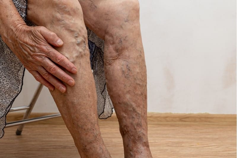 Common Legs Issues for Seniors and the Great Saphenous Vein - Oasis ...